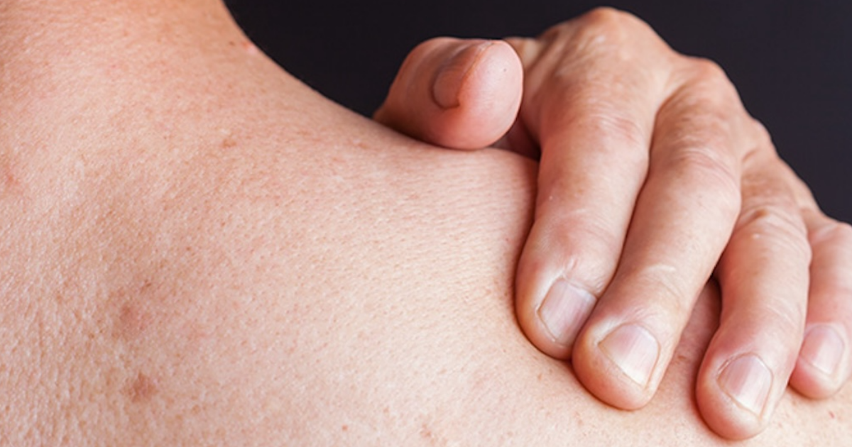 Traitement antiviral contre le zona | Accès pharma