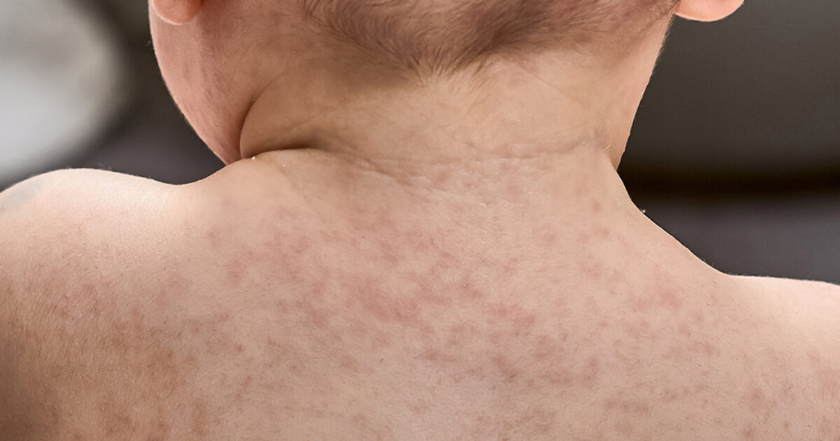 Roseola (sixth disease) | Accès pharma